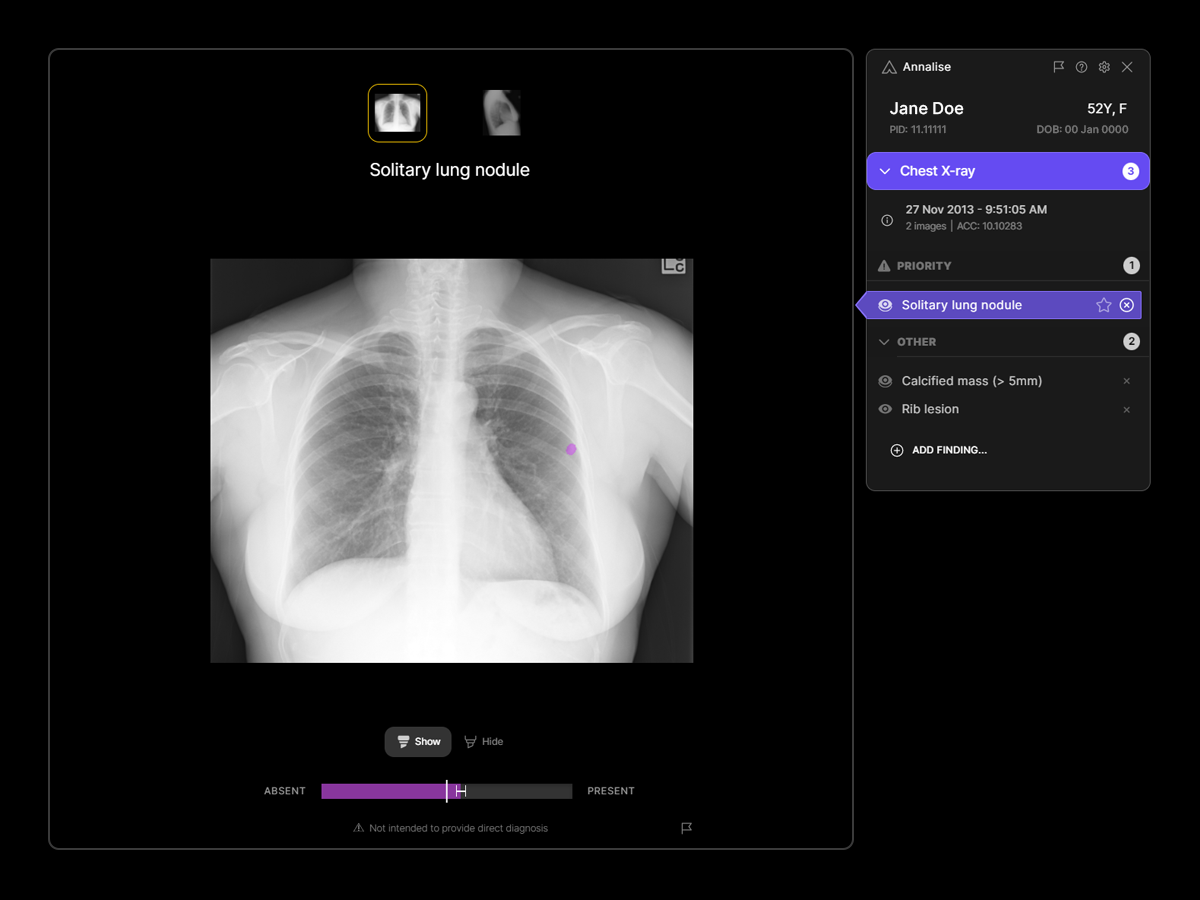 Artificial Intelligence solution to hasten lung cancer diagnosis | Magentus